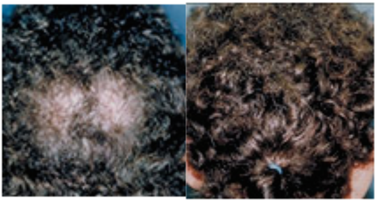 Scalp_Reduction | Beeson Cosmetic Surgery