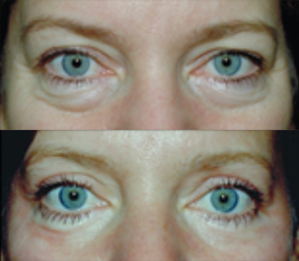 Lower_Eyelids | Beeson Cosmetic Surgery