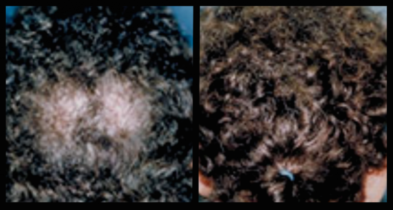 Scalp_Reduction | Beeson Cosmetic Surgery