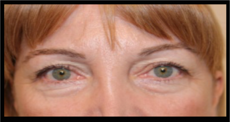 Bleph_Pic_2_Pre_V2 | Beeson Cosmetic Surgery