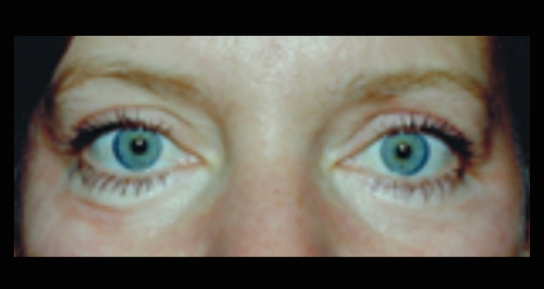 Bleph_Pic_6_Post_V2 | Beeson Cosmetic Surgery