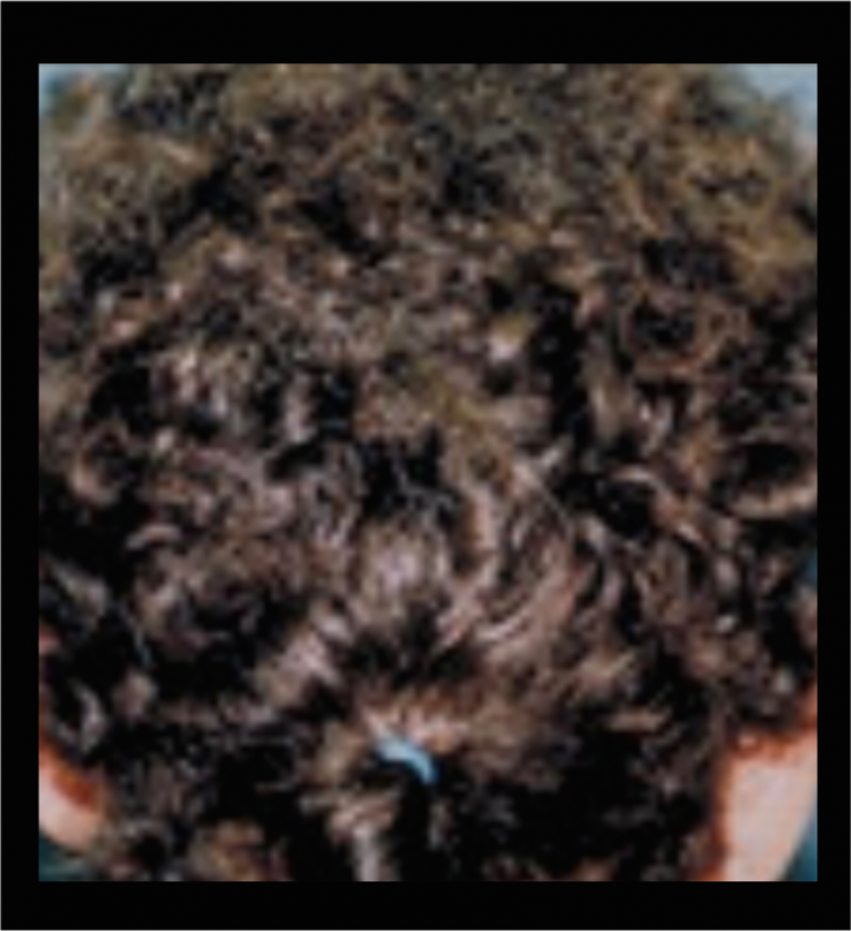 Scalp Reduction | Beeson Cosmetic Surgery